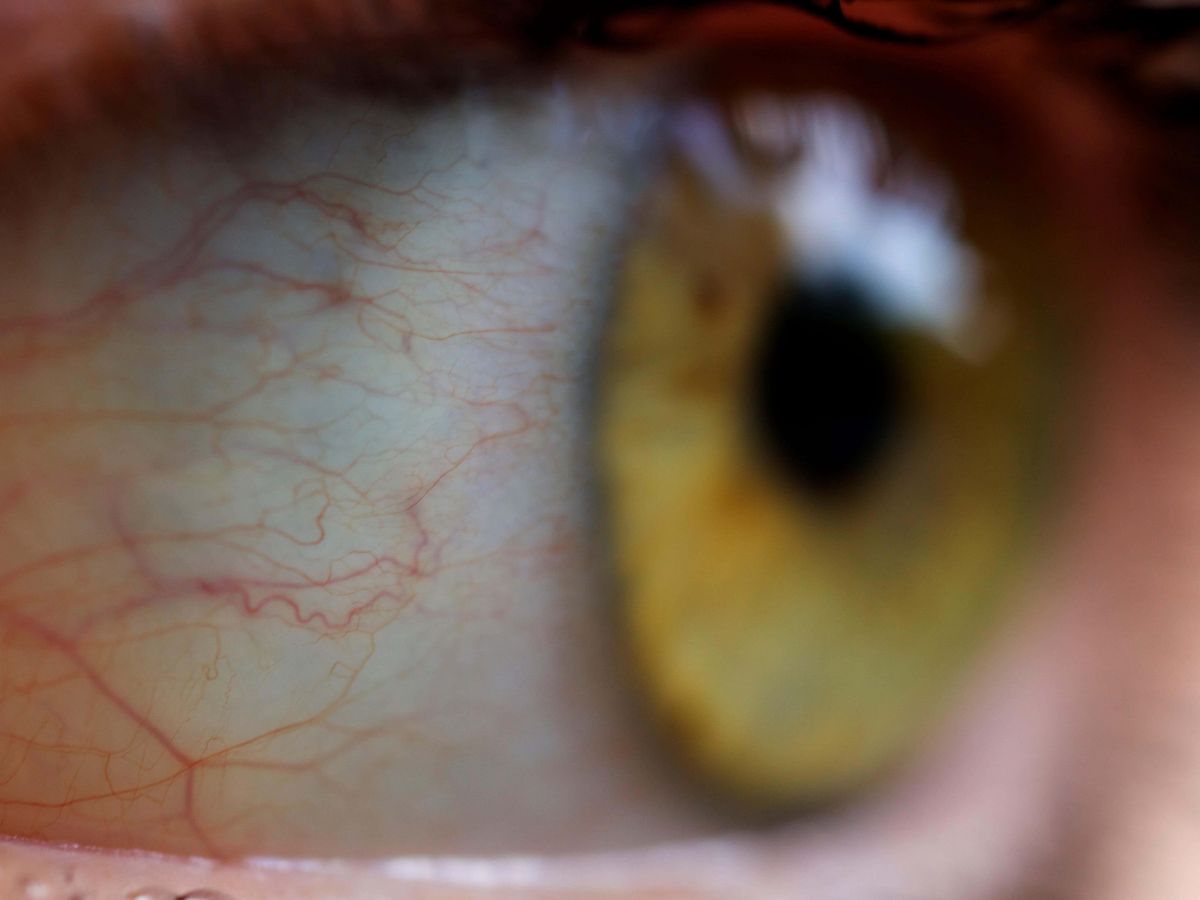 ‘Pioneering’ drug for rare eye cancer to be rolled out on NHS in ...